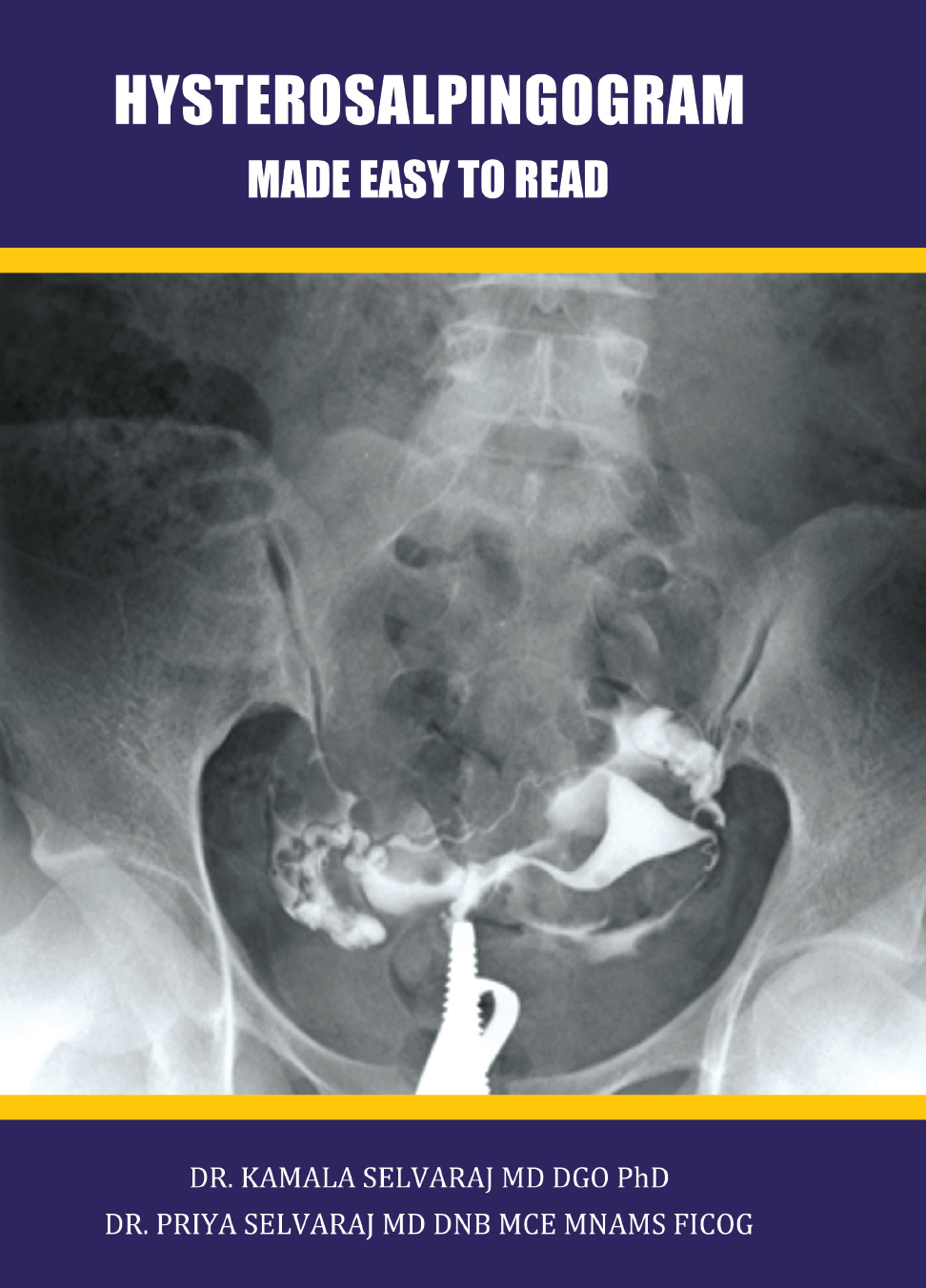 Hysterosalphingogram: Made Easy to Read by Dr. Kamala Selvaraj MD DGO Phd